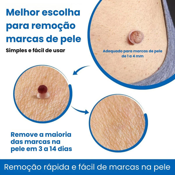 Acrolift – Mepezoo